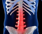 Lumbar Spinal Instability | As Spine Experts, We treat this condition