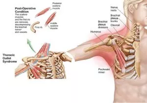 Thoracic Outlet Syndrome | We Treat this condition | Call Us