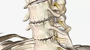 Cervical Bone Spurs can cause Pain. | We stop the Pain